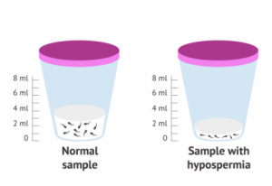 Hypospermia | Dr.Elton Peci