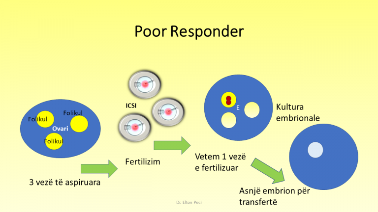 Poor Responder | Dr.Elton Peci