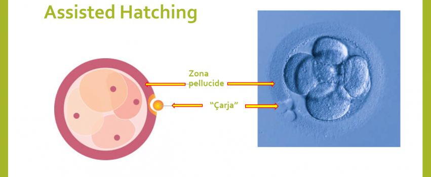 Assisted Hatching | Dr.Elton Peci