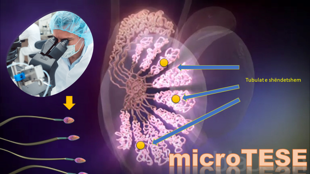 Micro – TESE | Dr.Elton Peci
